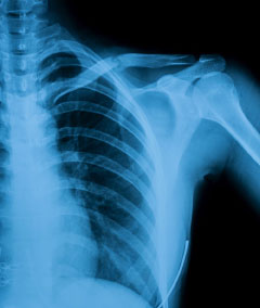 The mysteries of rib dysfunction - Cayman Compass