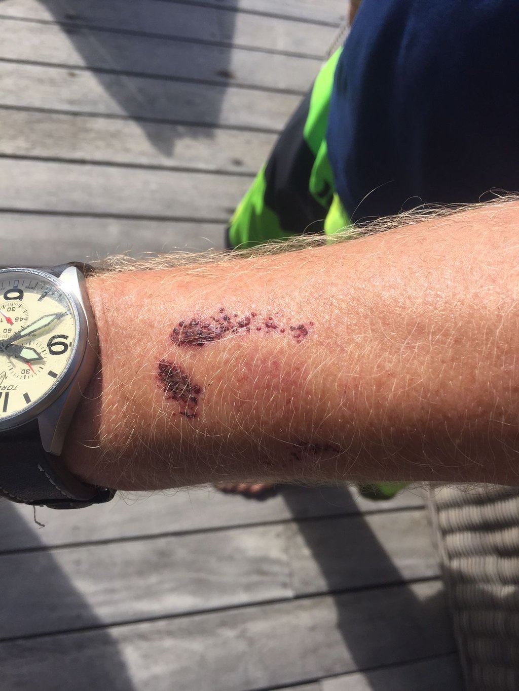 Bronson stingray bite - Cayman Compass