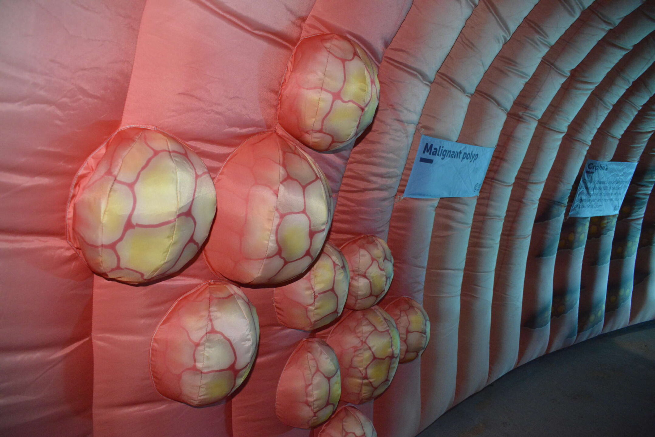 Giant inflatable colon centrepiece of Lions men's health evening ...